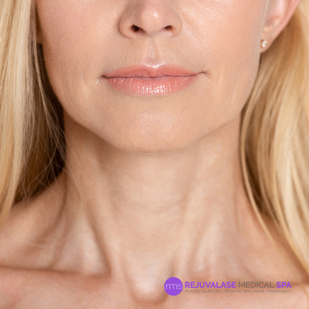 How to Achieve a Snatched Neck: 3 Expert-Approved Treatments at Rejuva ...